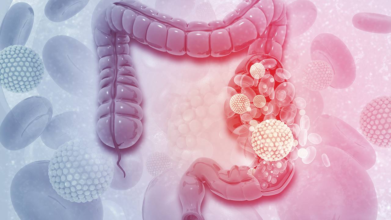 Cáncer de colon se puede curar en el 90% de los casos - Banca y Negocios
